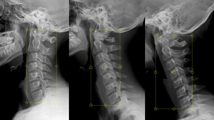 Computer Vision Tutorial: Lateral Cervical - PostureScreen, LeanScreen ...