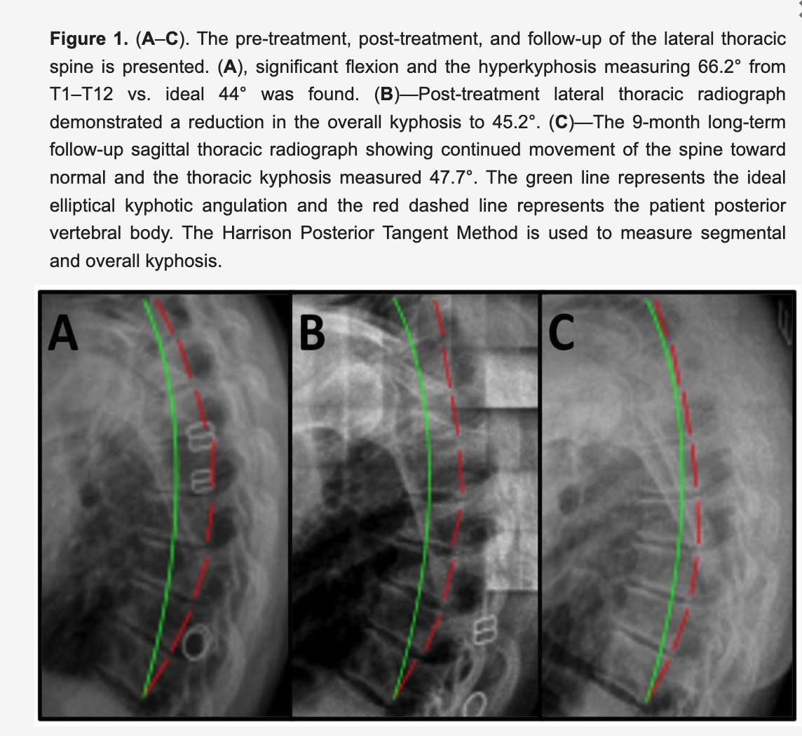 Case Report Highlights the Role of PostureRay® in Correcting Chronic ...